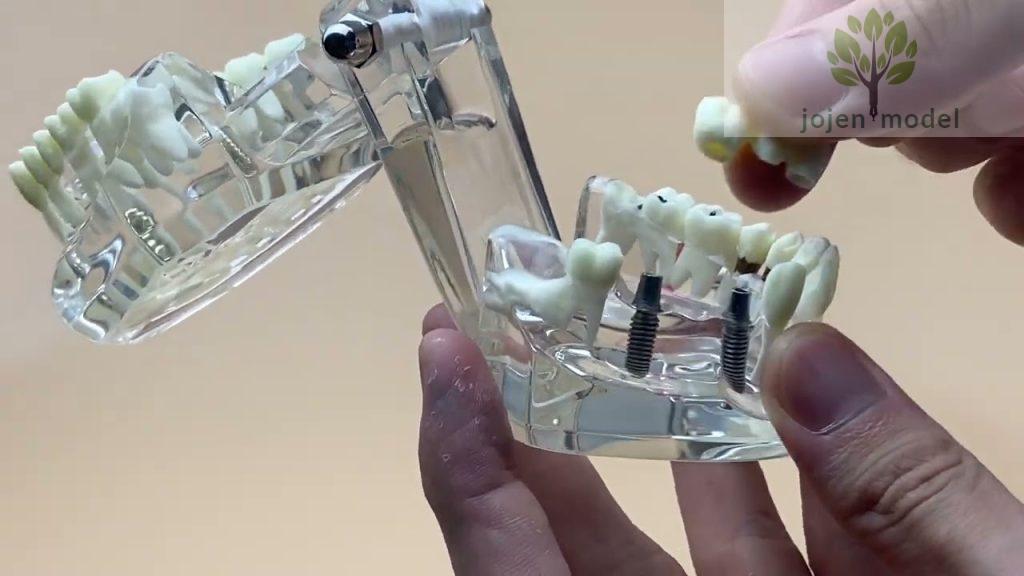 implant model bone China Best Company,Dental implant models price China ...